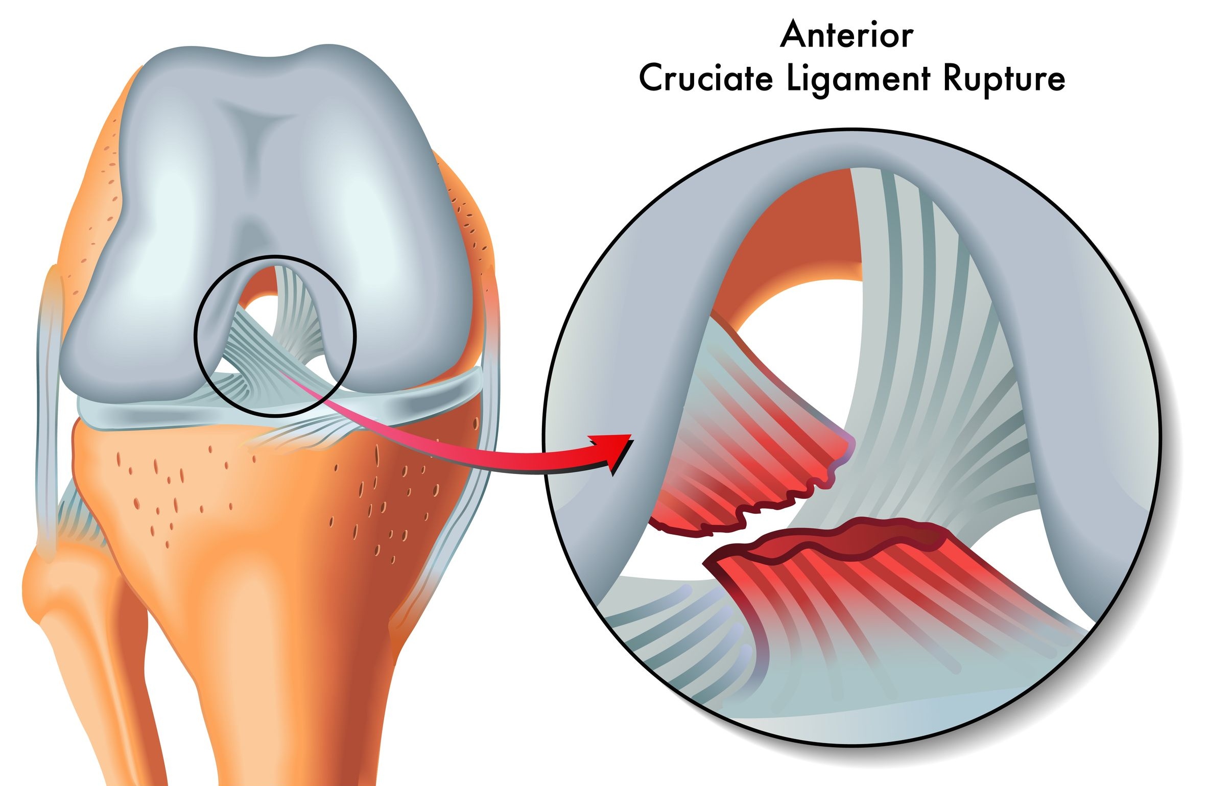 Anterior Cruciate Ligament repair | Dr. Michael Serhal